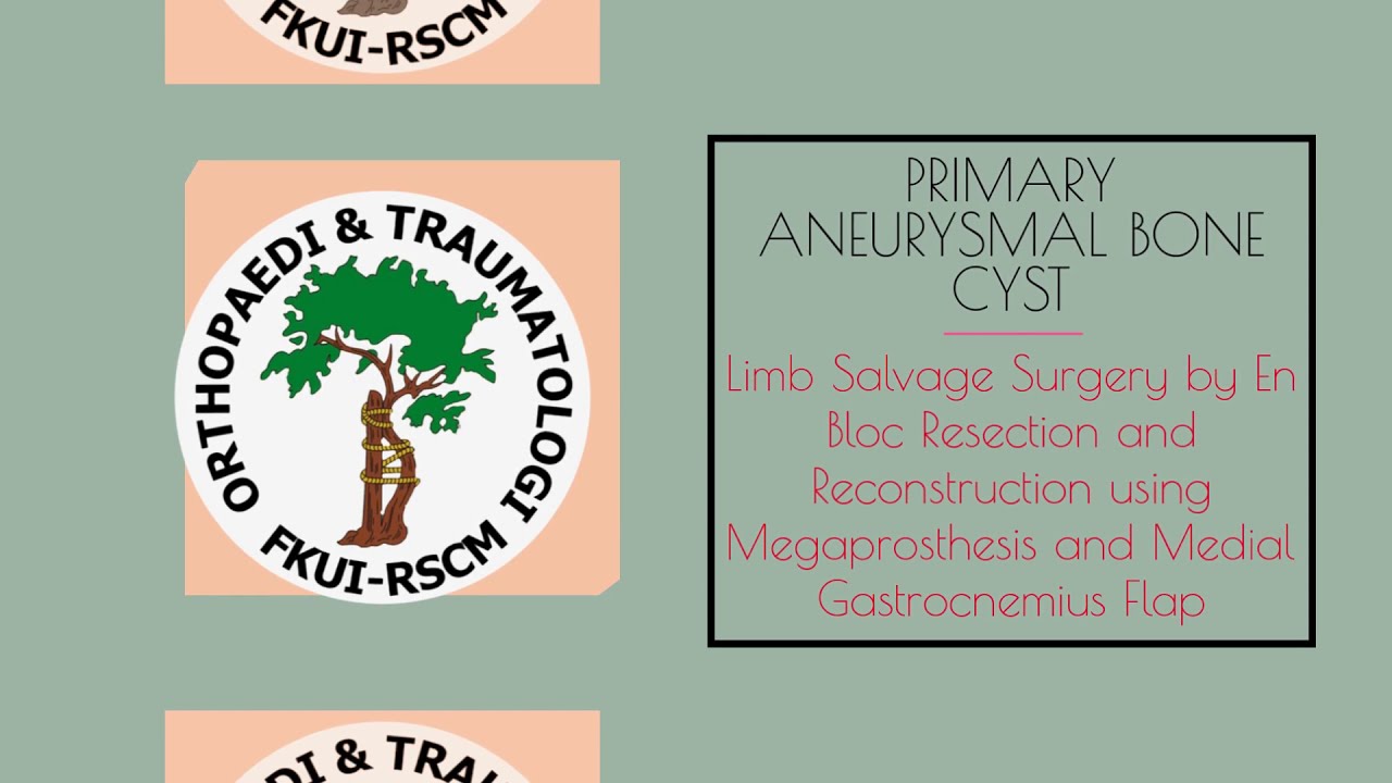 Megaprosthesis Reconstruction in Aggressive Aneurysm Bone Cyst of ...